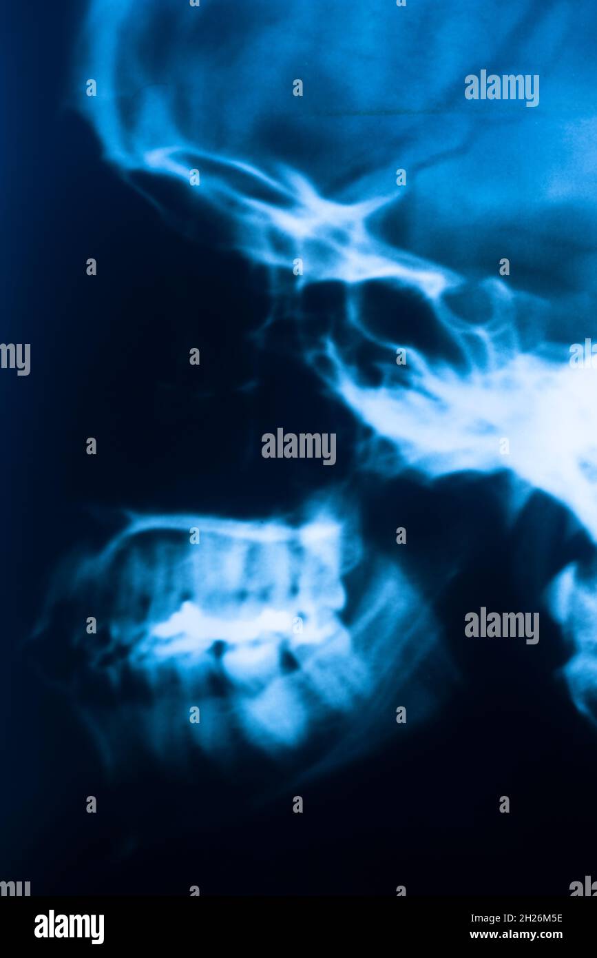 Xray scan skull nose medical exam results from hospital clinic Stock ...