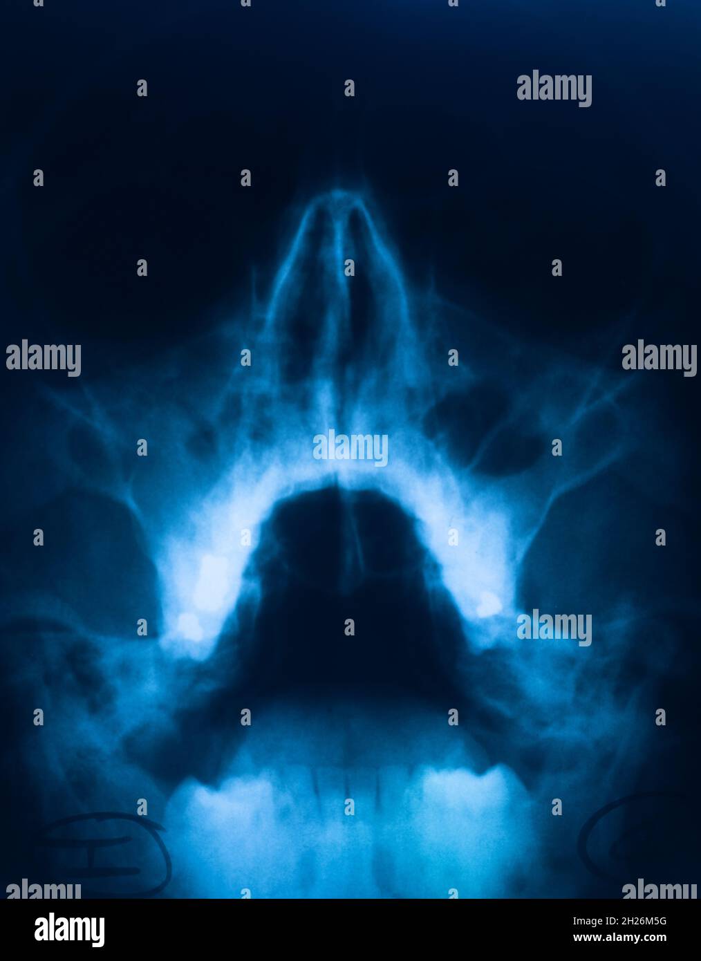 Xray scan skull nose medical exam results from hospital clinic Stock ...