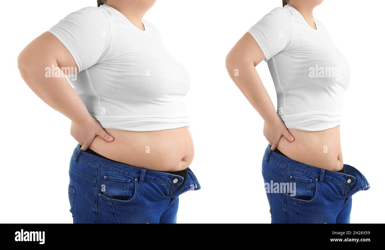 Woman stomach plastic surgery Cut Out Stock Images & Pictures - Alamy