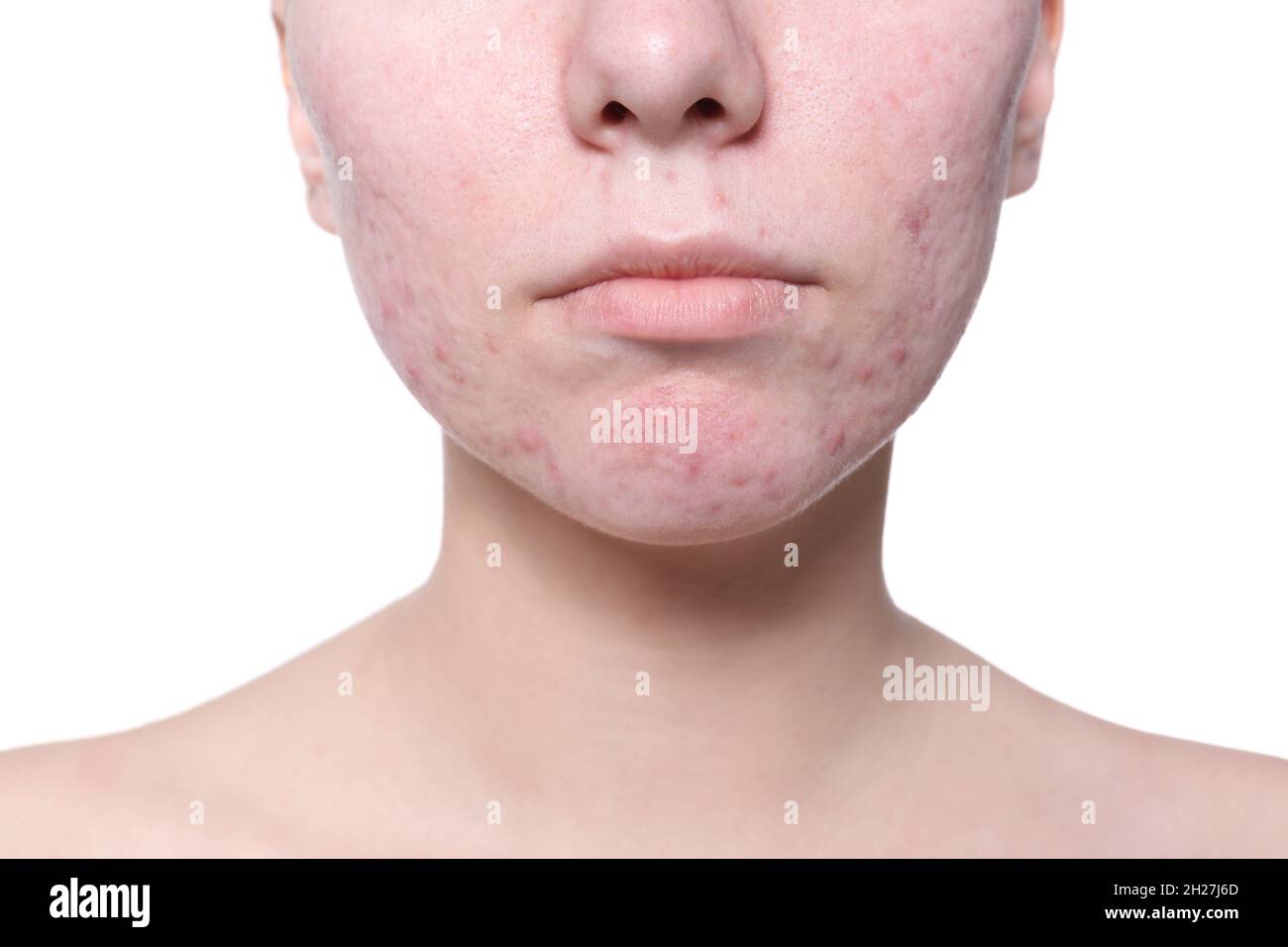 Young woman with acne problem on white background Stock Photo - Alamy
