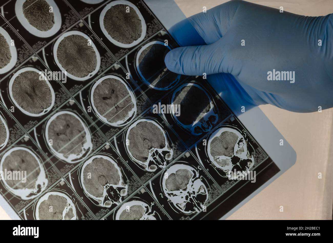 Neurosurgeon wearing blue medical glove holds Series of CAT Scans ...