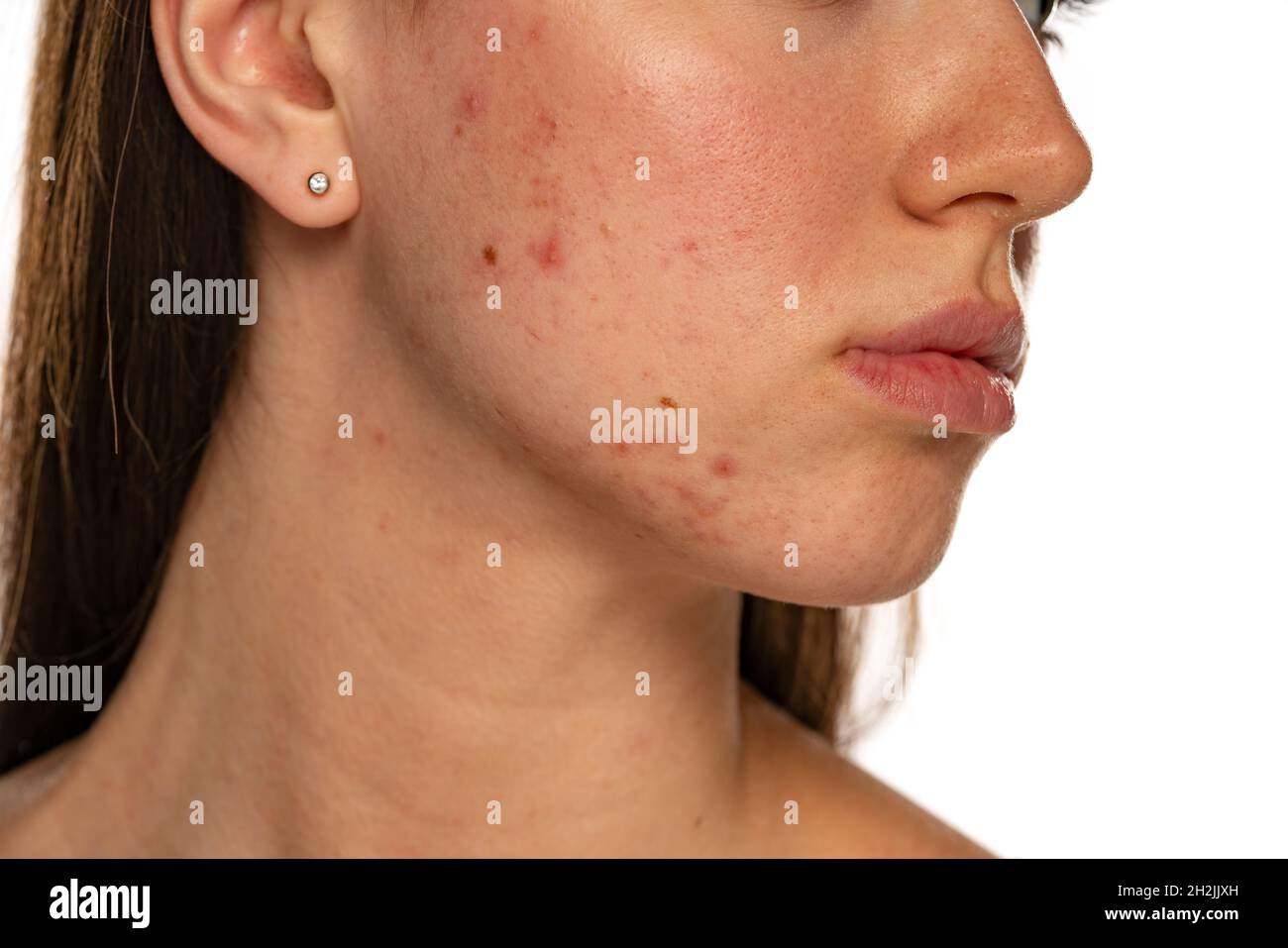 Closeup of a female face with problematic skin on a white background ...