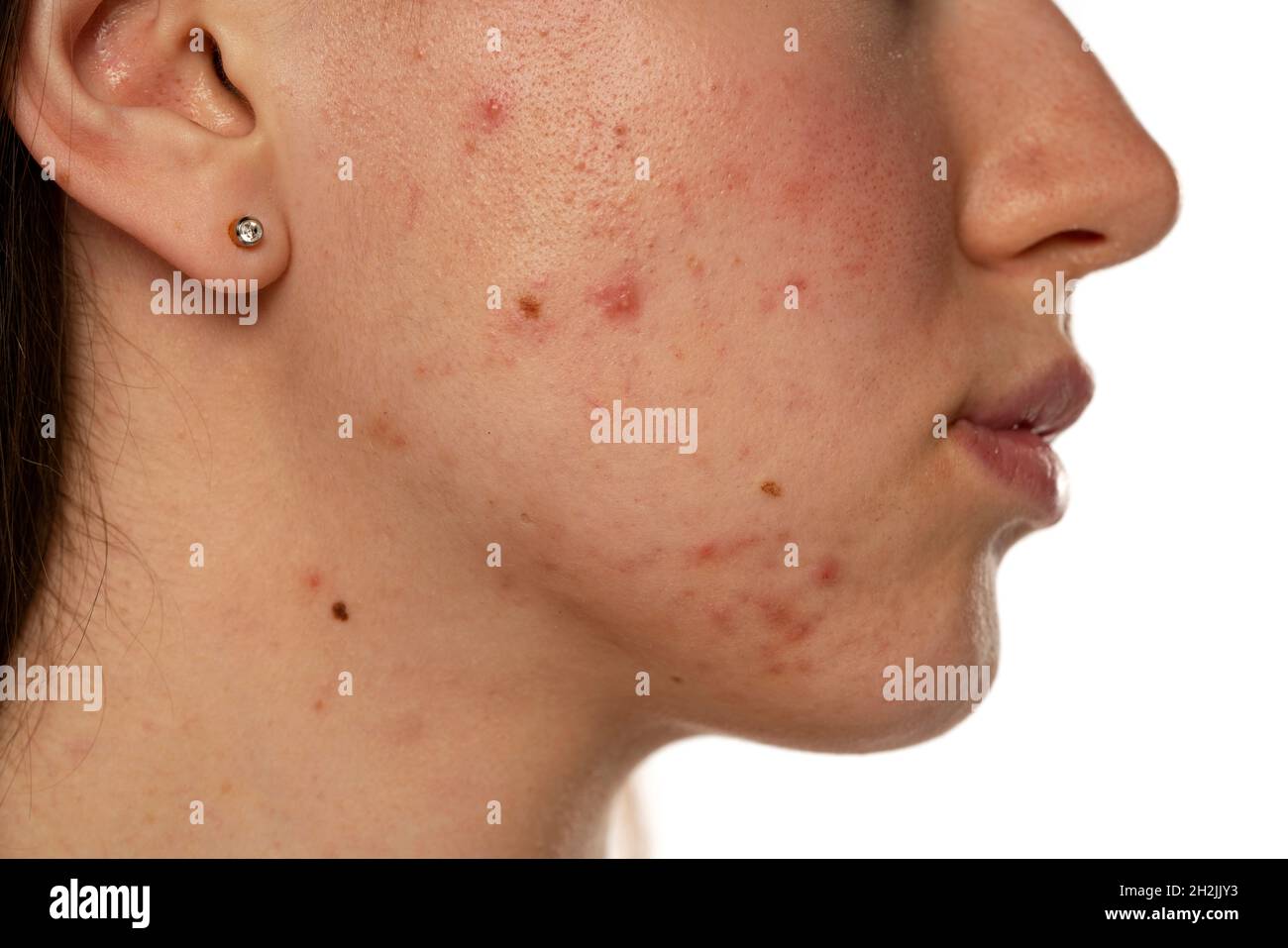 Closeup of a female face with problematic skin on a white background ...
