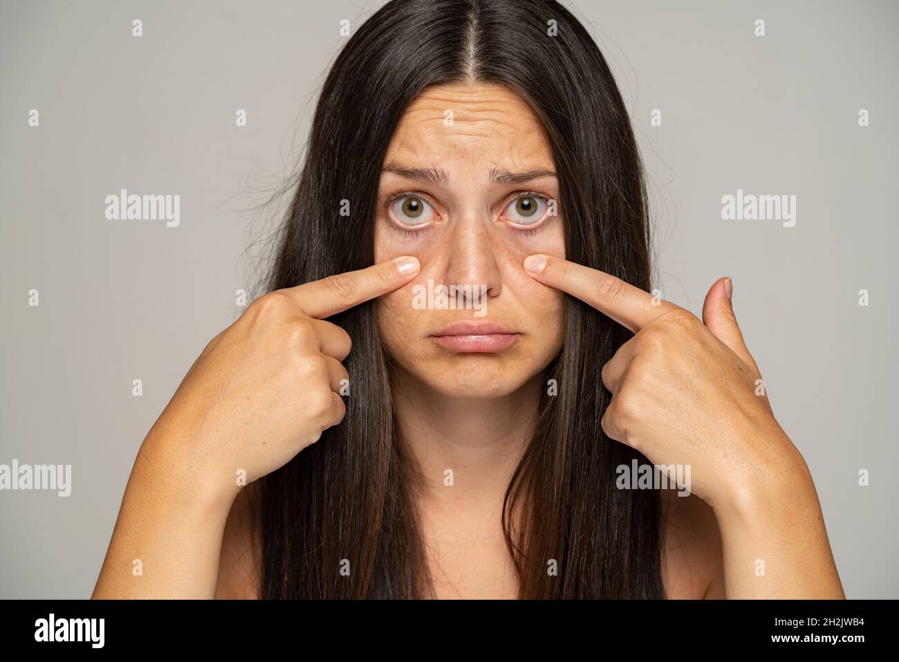 Funny Unhappy Woman Pulling Down Her Lower Eyelids On Gray Background ...