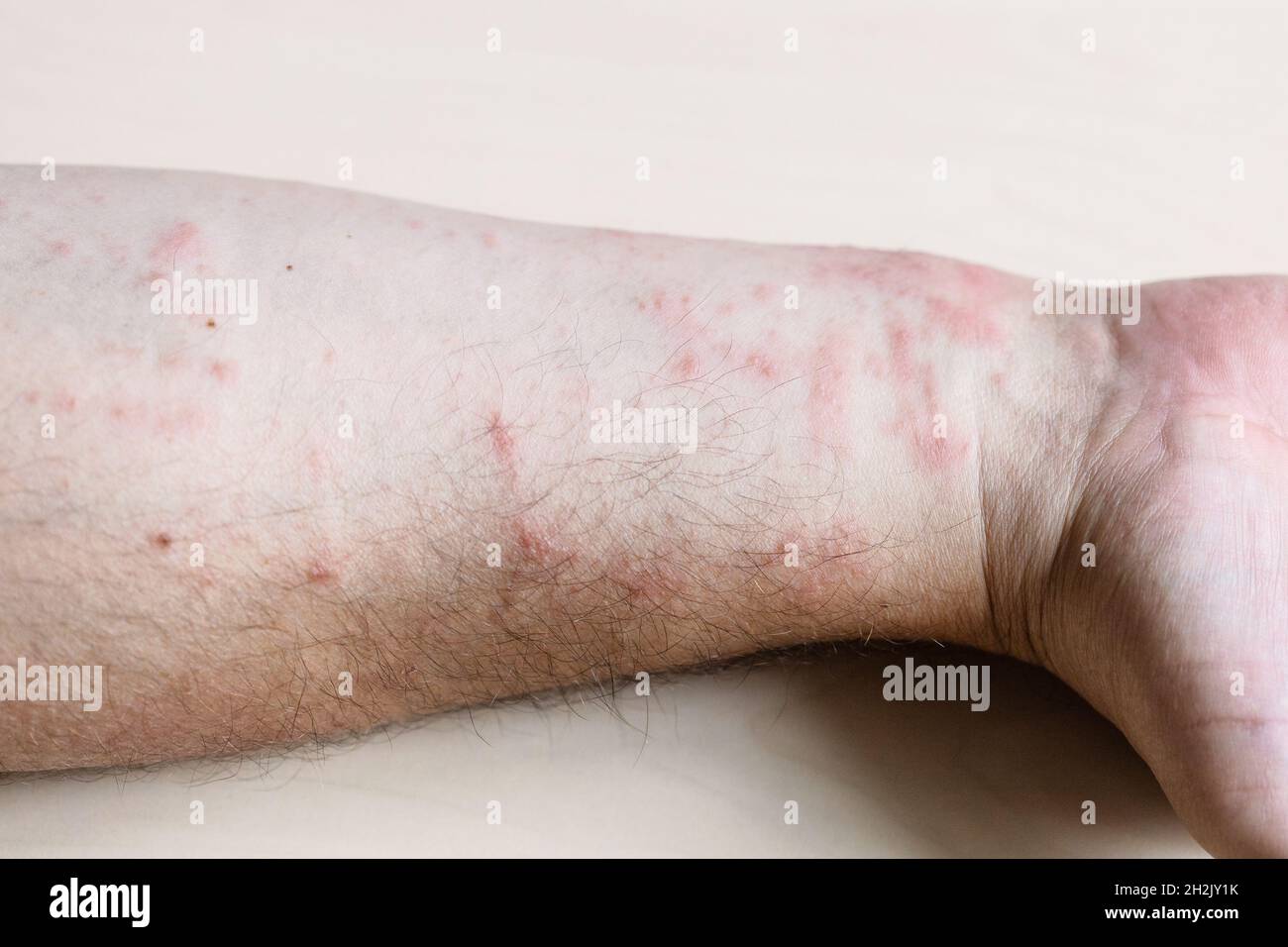 sample of Allergic contact dermatitis - skin inflammation on inner side ...
