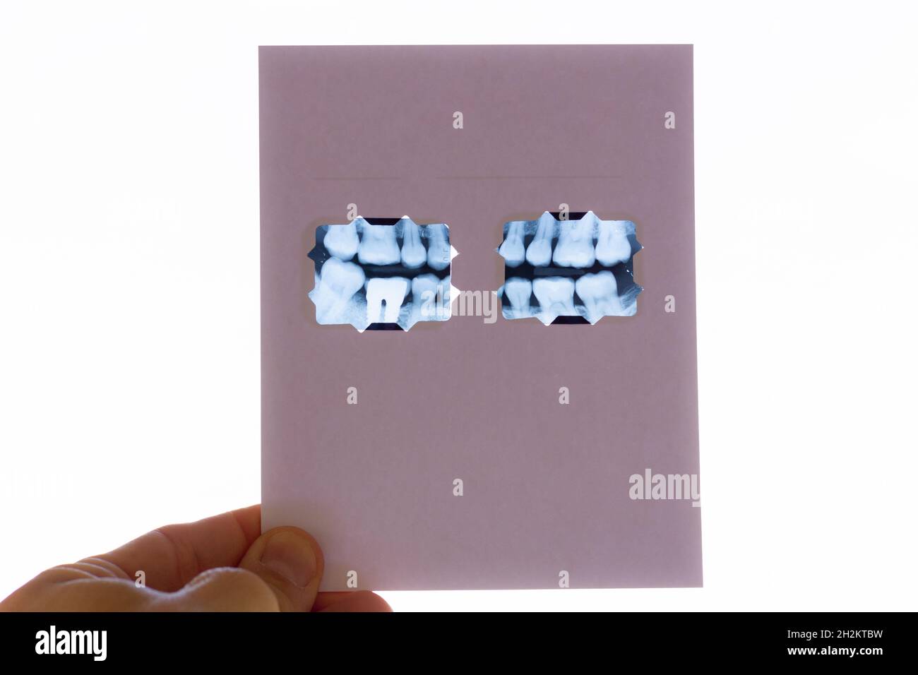 Hand of dentist holding teeth radiography chart backlit. X-ray, oral ...