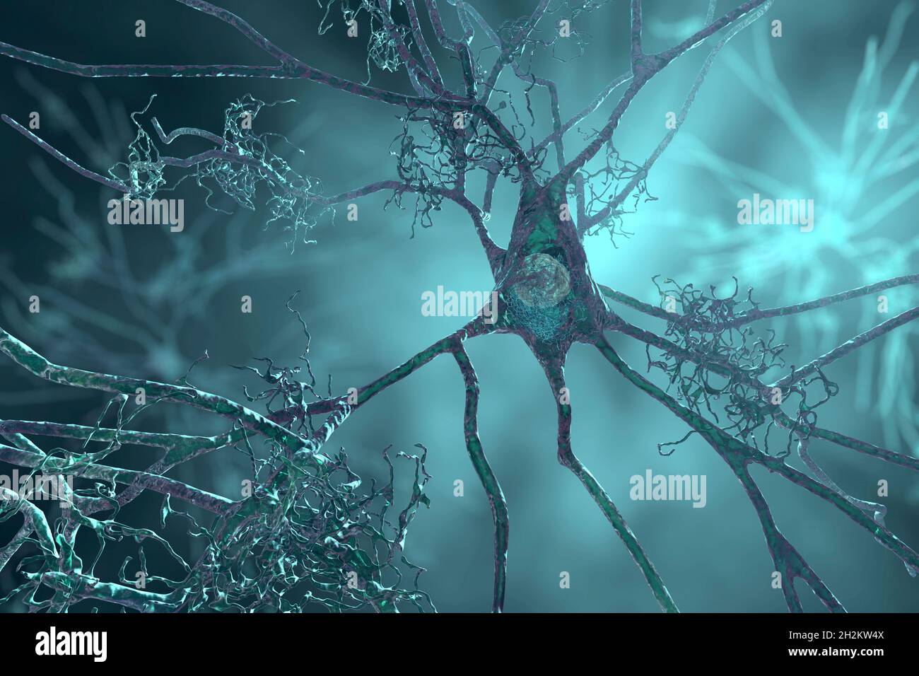 Nerve cells affected by Alzheimer's disease, illustration Stock Photo ...