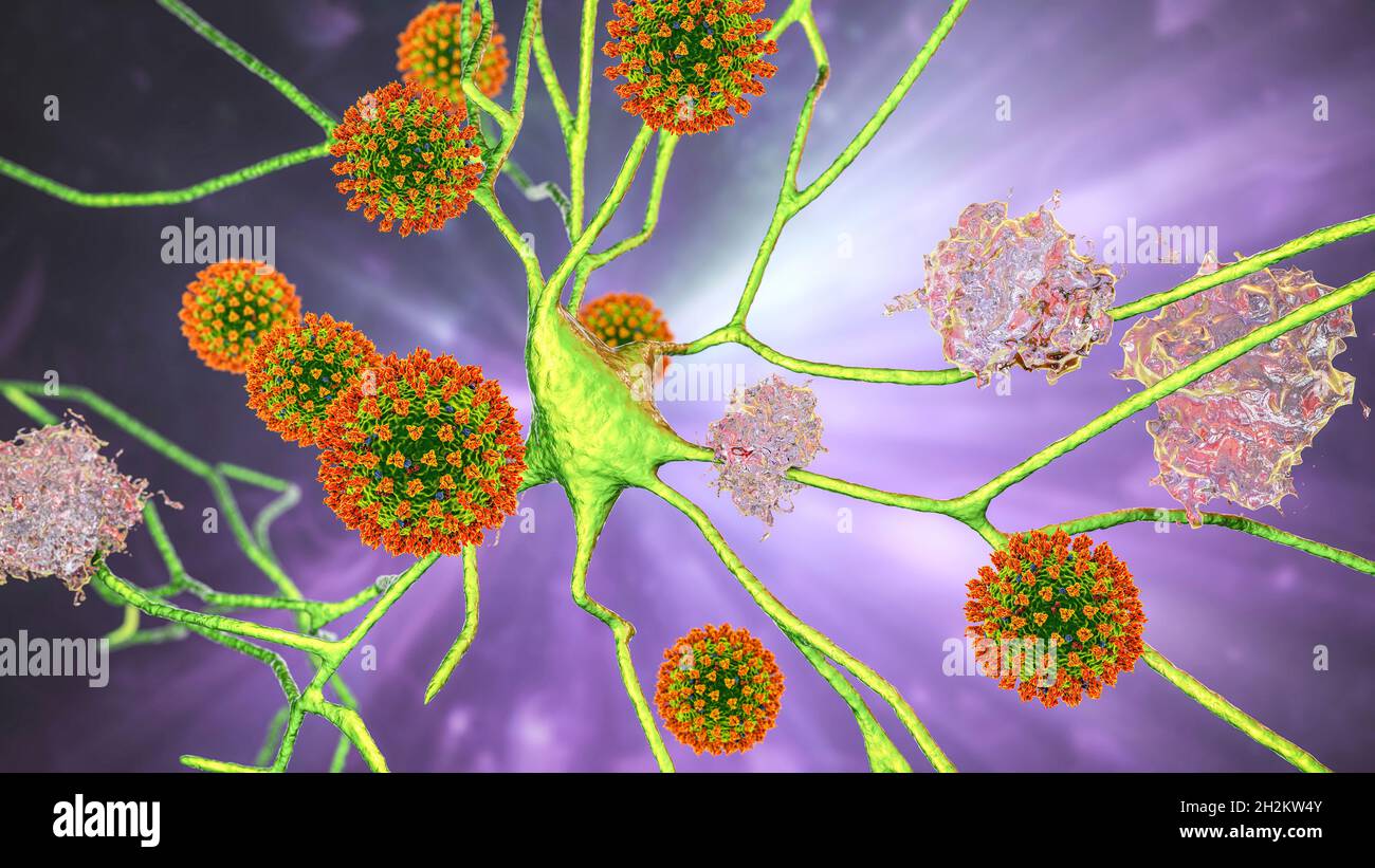 Infectious etiology of dementia, conceptual illustration Stock Photo ... Infectious etiology of dementia, conceptual illustration Stock Photo ...