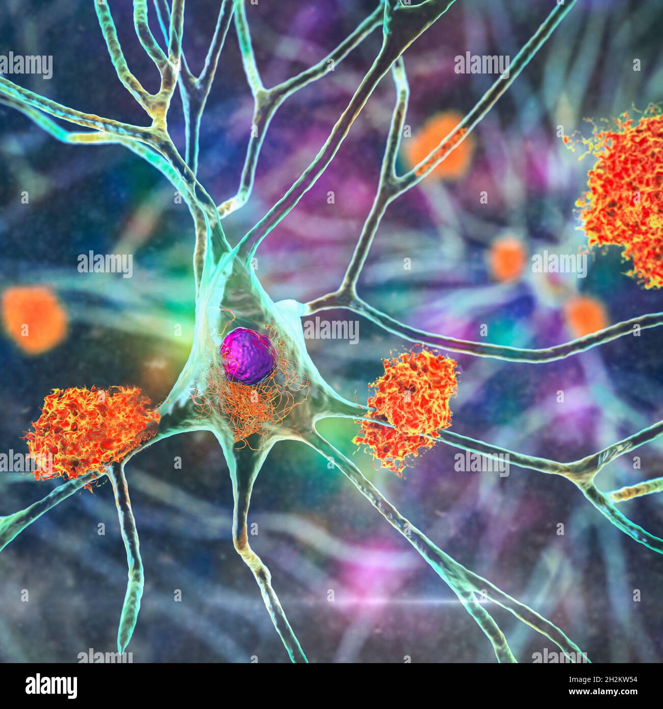 Nerve cells affected by Alzheimer's disease, illustration Stock Photo ...