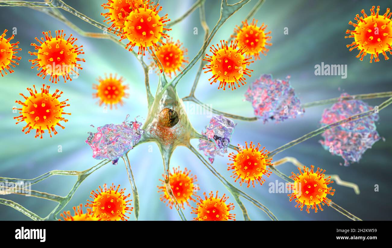 Infectious etiology of dementia, conceptual illustration Stock Photo ... Infectious etiology of dementia, conceptual illustration Stock Photo ...