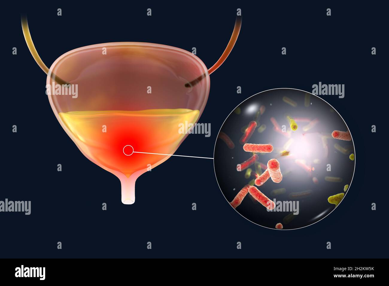 Bacterial cystitis, illustration Stock Photo - Alamy