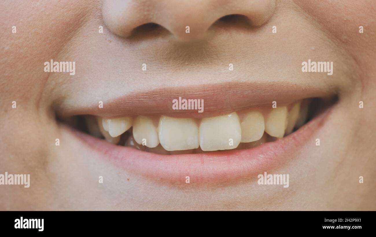 A young girl smiles and shows her crooked teeth Stock Photo - Alamy