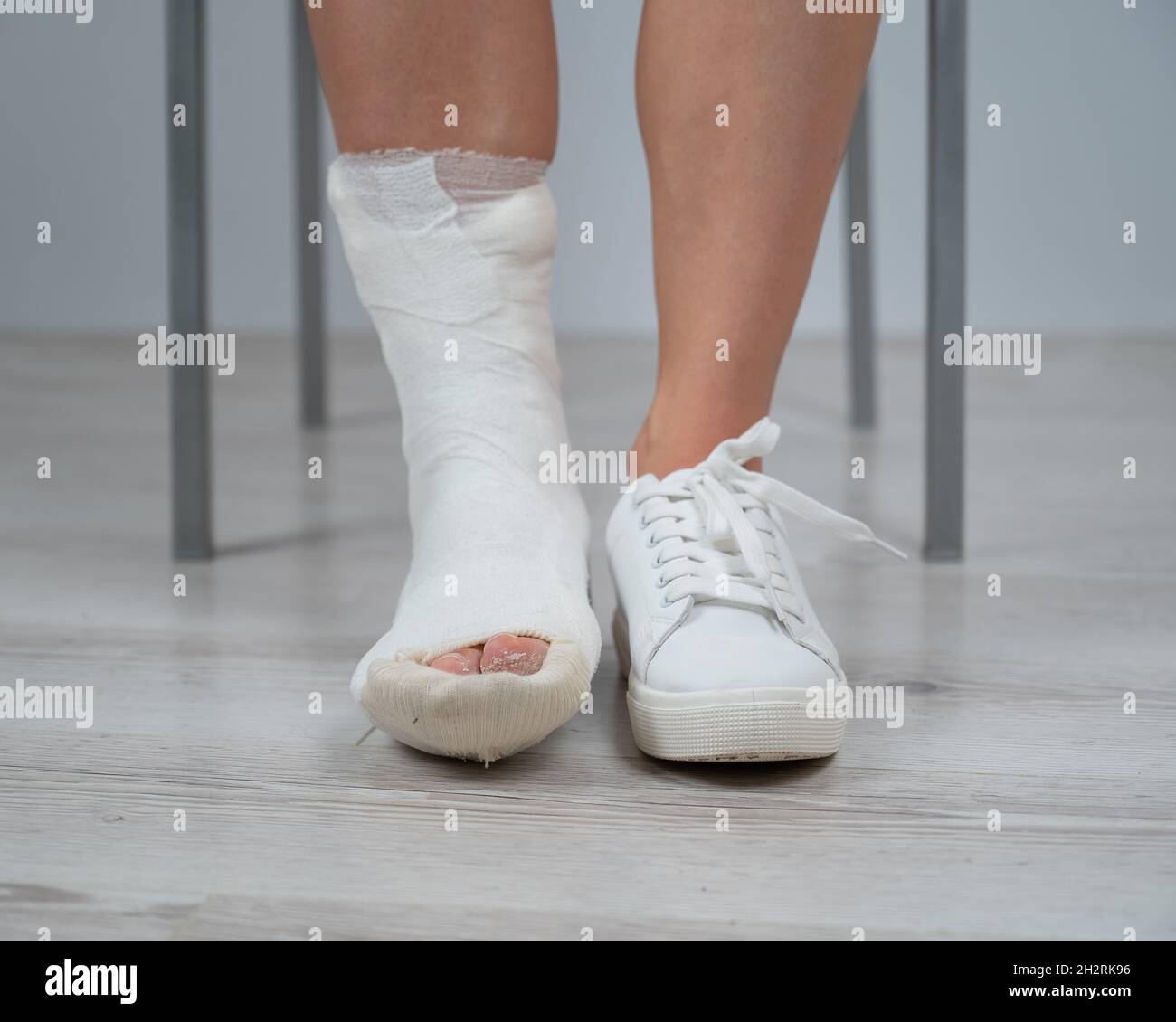 Close-up of female legs with plaster cast. A woman with a broken leg ...