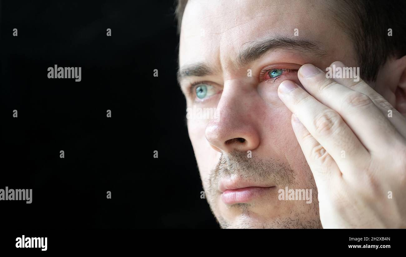 Sad Man Touch His Severe Bloodshot Red Blood Eye Affected by ...