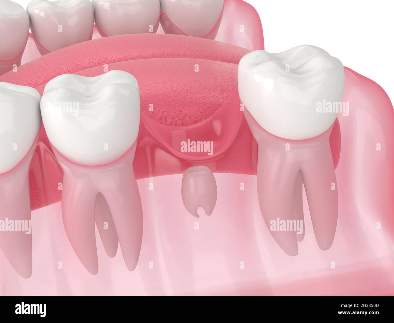 Permanent molars hi-res stock photography and images - Alamy