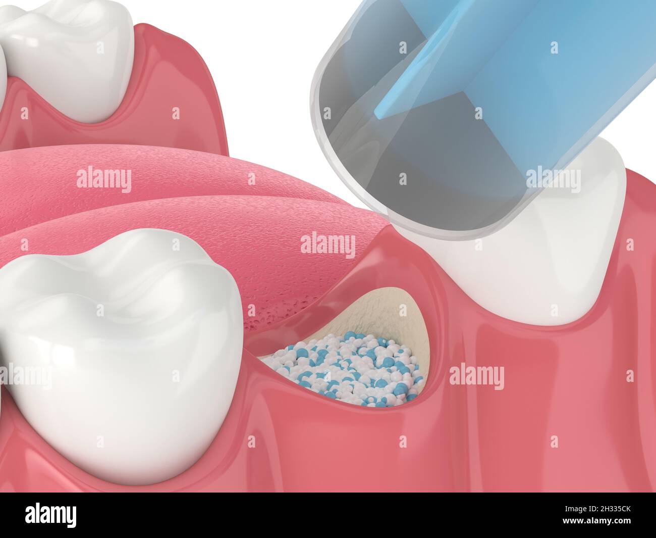 3D render of dental bone grafting with dental bone biomaterial ...
