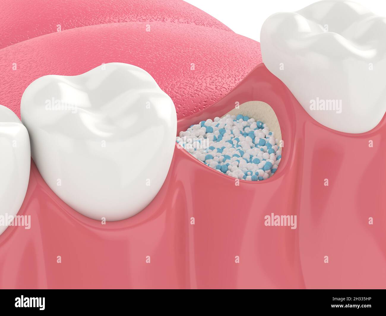 3D render of dental bone grafting with dental bone biomaterial in ...