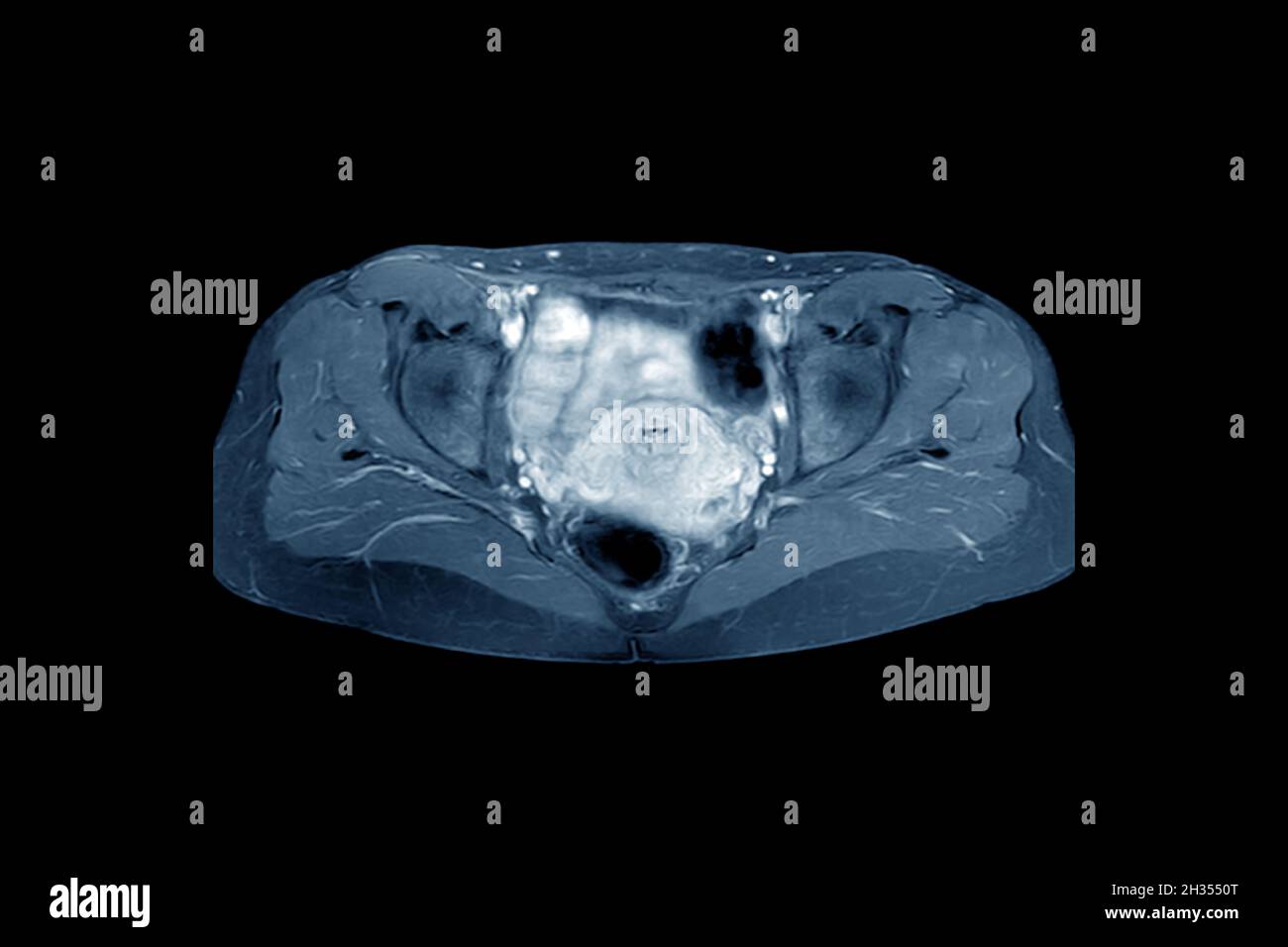 Magnetic Resonance Imaging Pelvic of a Healthy Woman finding ...