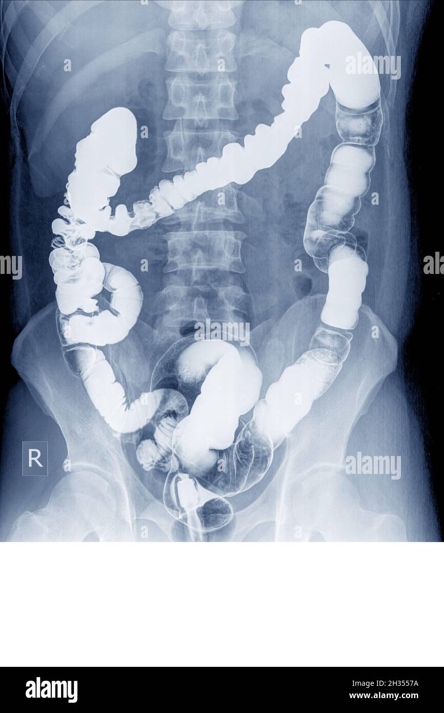 Cecum examination hi-res stock photography and images - Alamy