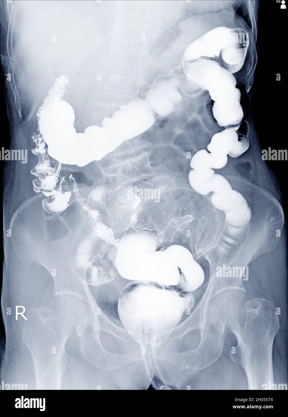 Radiological examination to look for colon abnormalities By enema the ...