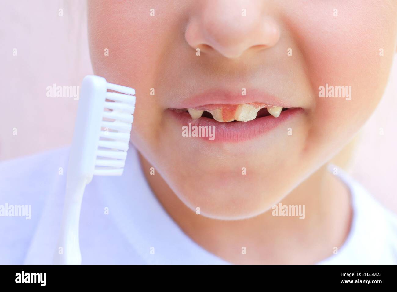 Blood on the teeth of a child Stock Photo - Alamy