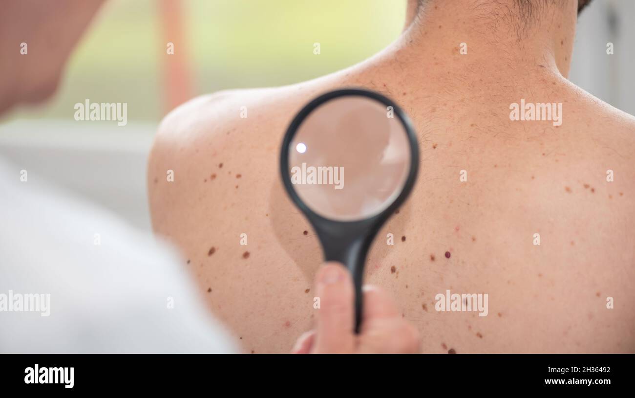 Dermatologist examining the skin of patient back Stock Photo - Alamy