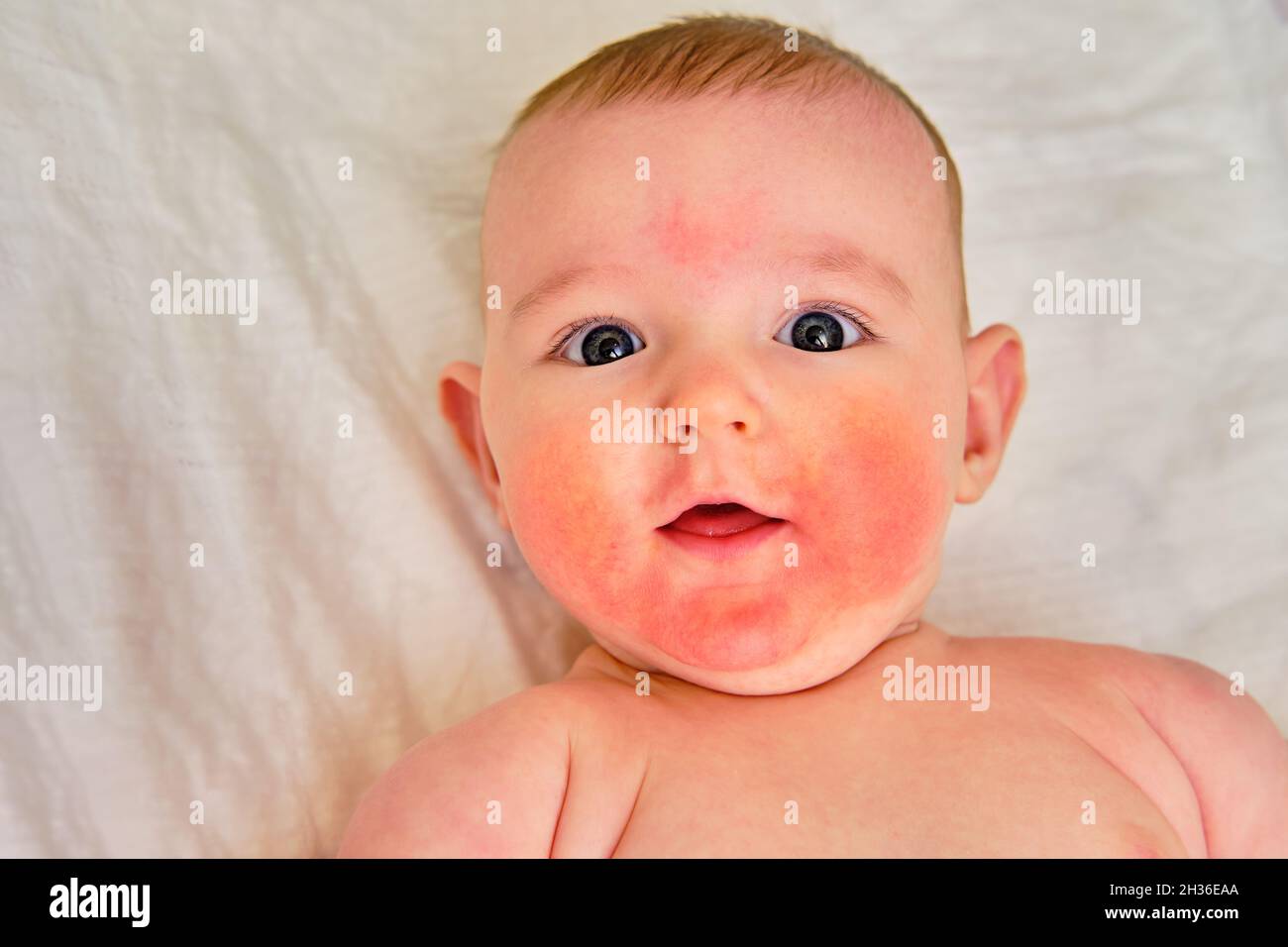 Portrait of a happy infant baby with allergies, red skin dermatitis ...