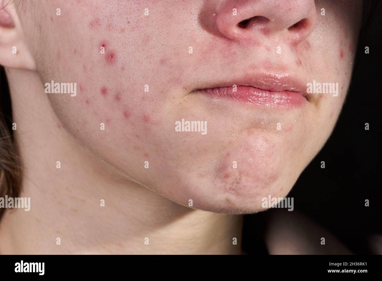 Close up of teenager problematic face skin with acne Stock Photo - Alamy