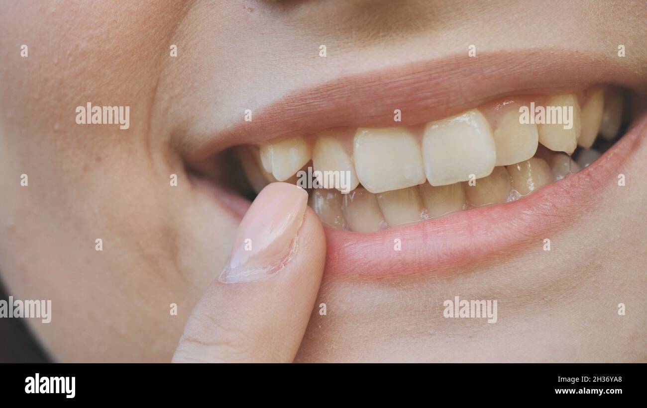 A young girl smiles and shows her crooked teeth Stock Photo - Alamy