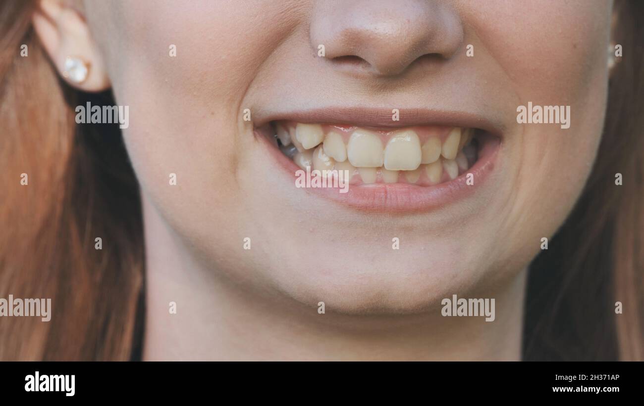 A young girl smiles and shows her crooked teeth Stock Photo - Alamy