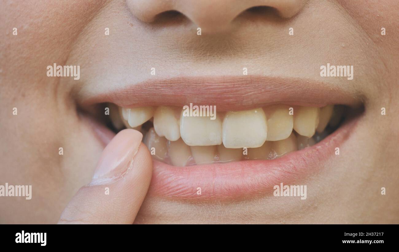 A young girl smiles and shows her crooked teeth Stock Photo - Alamy