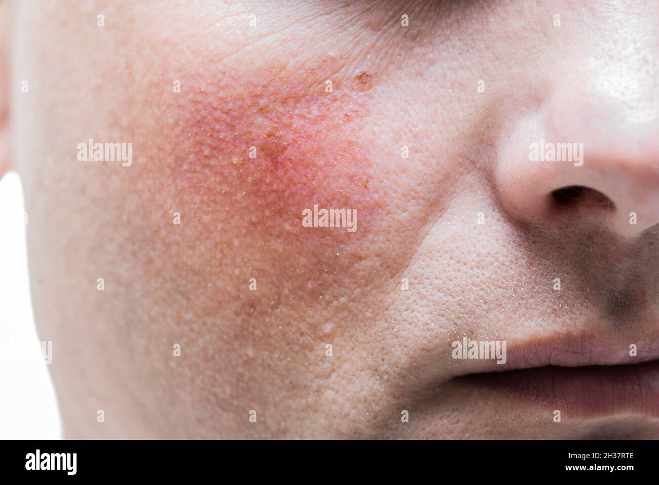 Red face, broken blood vessels, health problems Stock Photo - Alamy