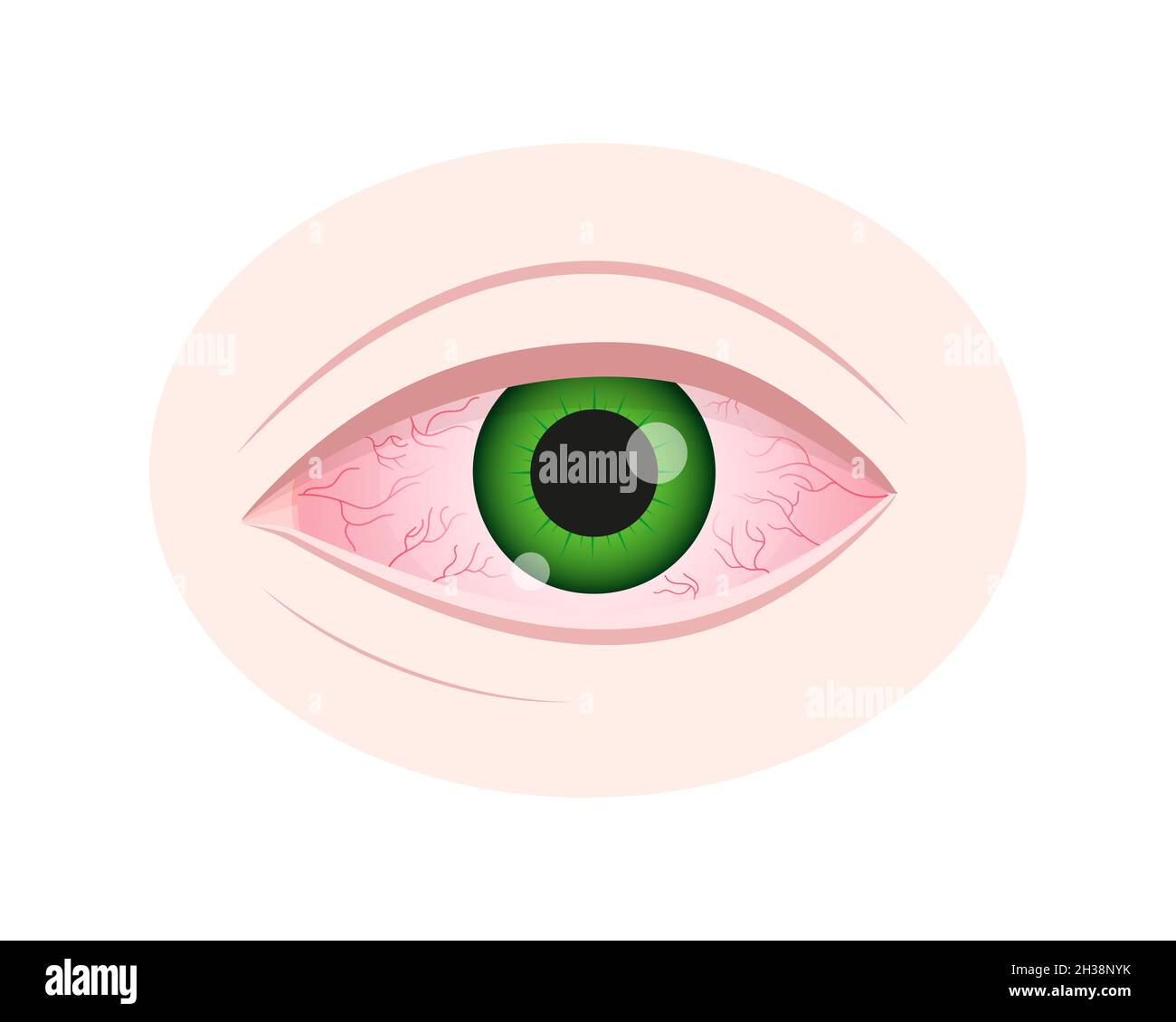 Uveitis Stock Vector Images - Alamy
