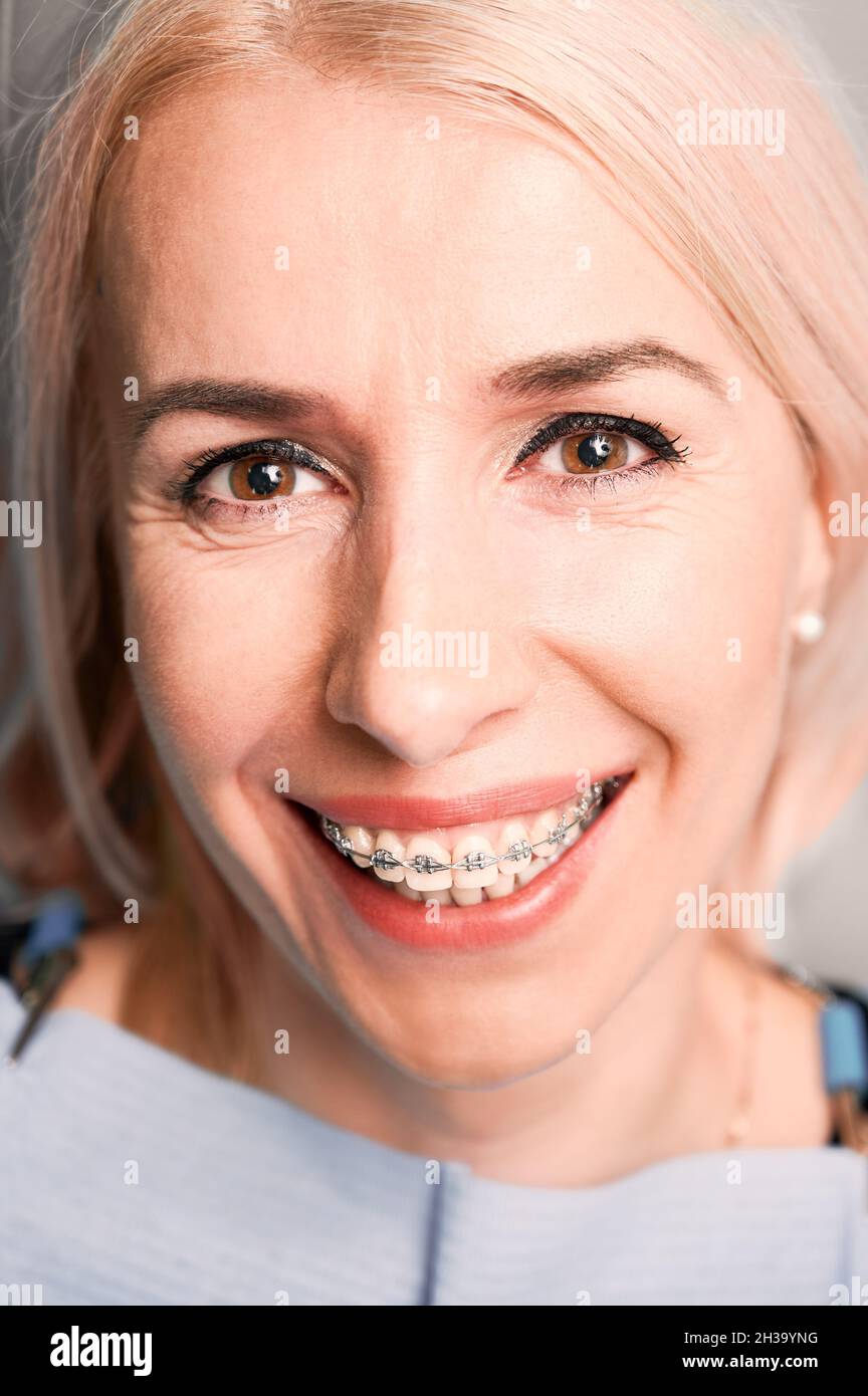 Close up of cheerful woman with orthodontic brackets on teeth looking ...
