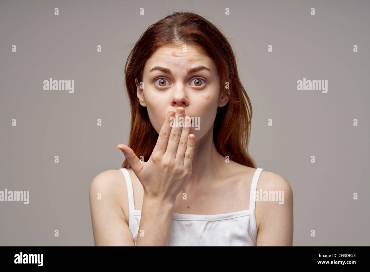 beautiful woman with pimples on the face hygiene light background Stock ...