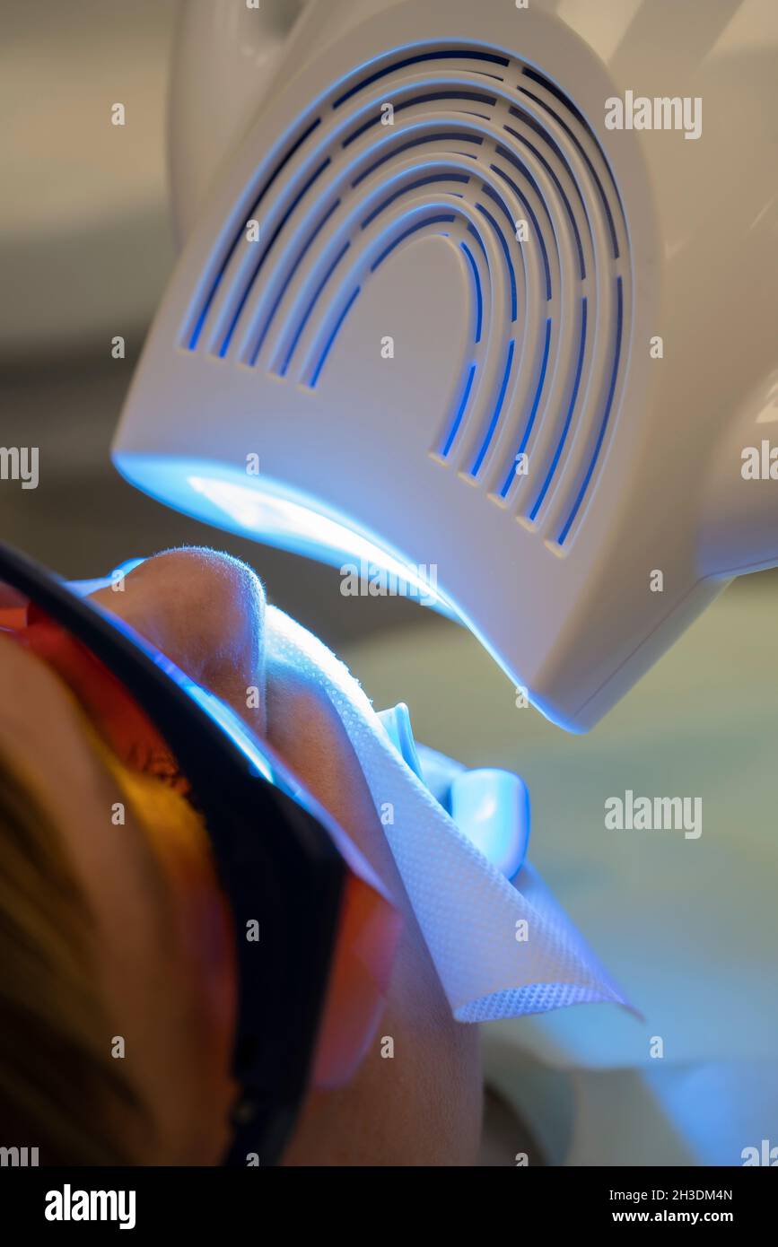 Professional Cold Blue Light Dental Whitening Unit in Dental Office ...