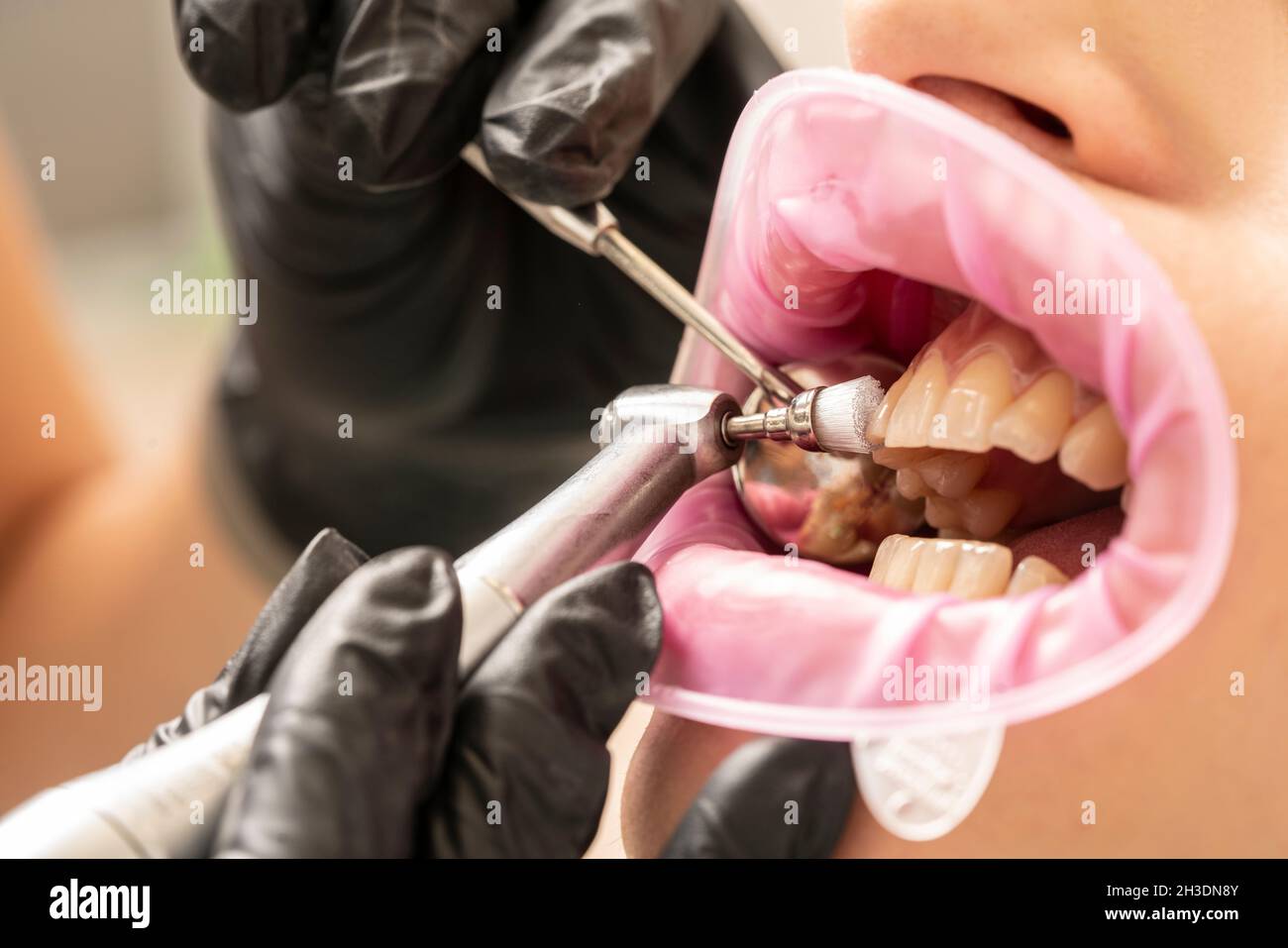 macro shoot of a dentist polishes his patient's teeth with a drill ...