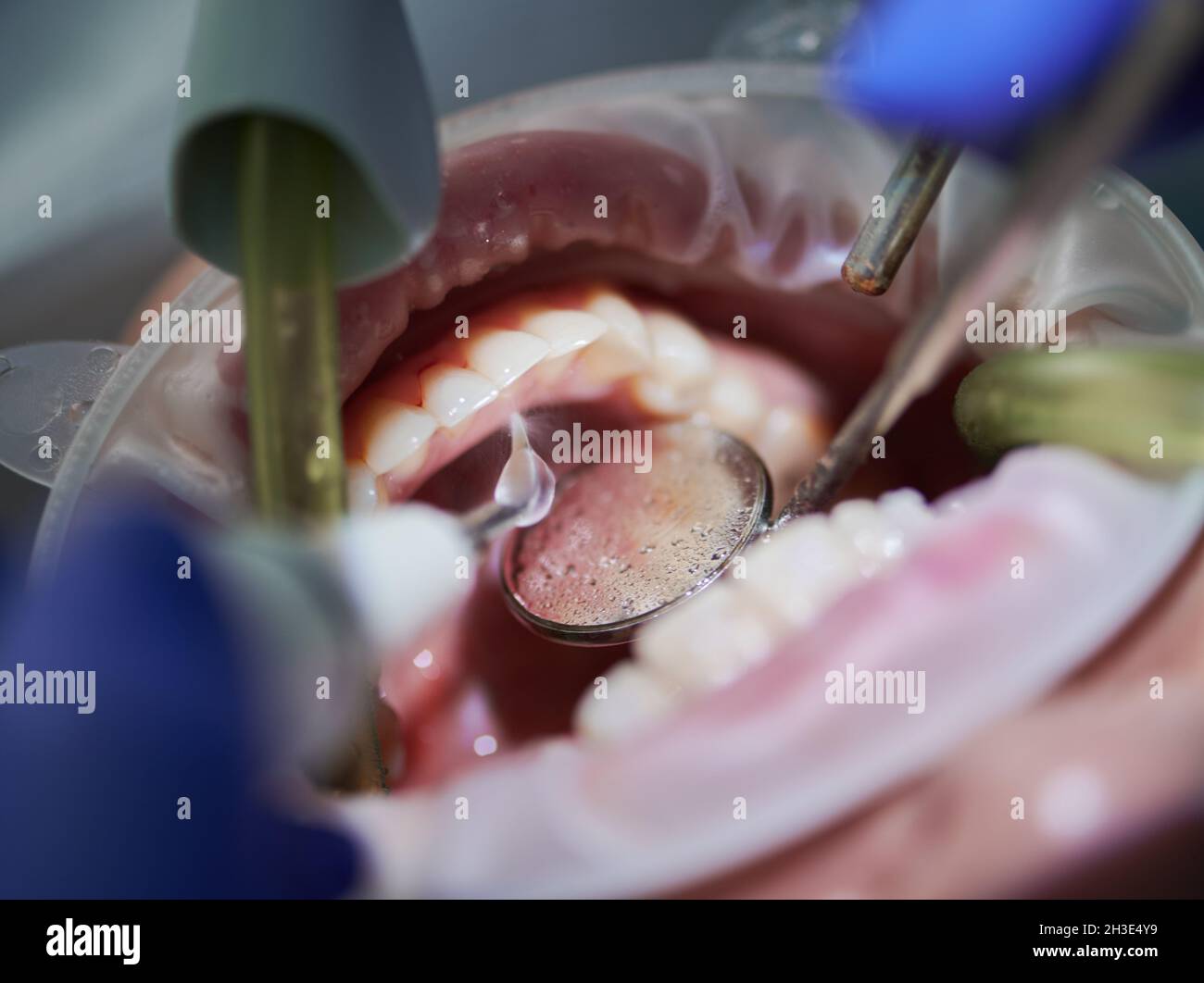 Close up of patient with cheek retractor in mouth receiving dental ...