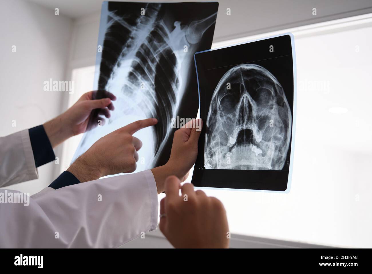Doctor skull fracture xray hi-res stock photography and images - Alamy