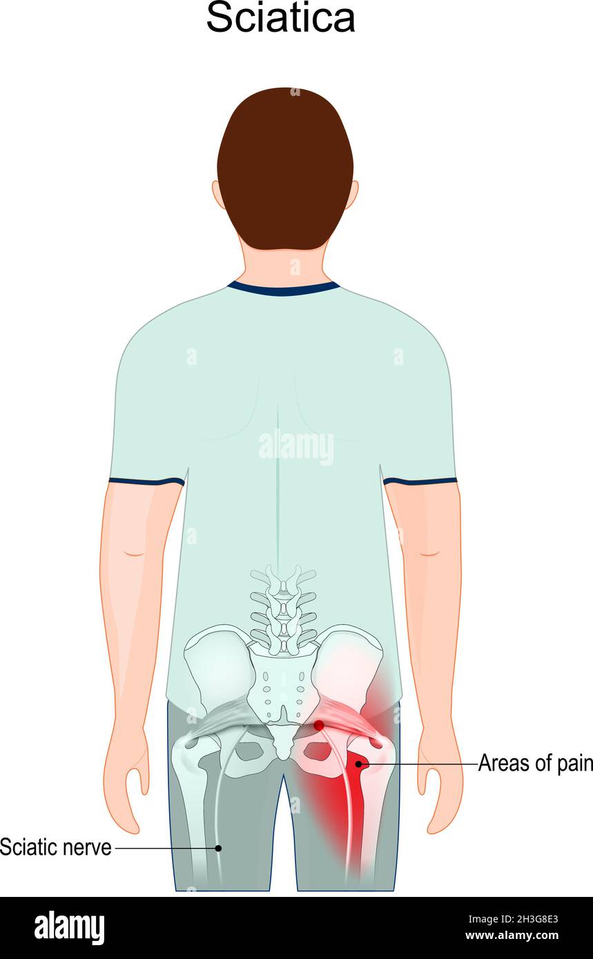 Sciatic hi-res stock photography and images - Alamy