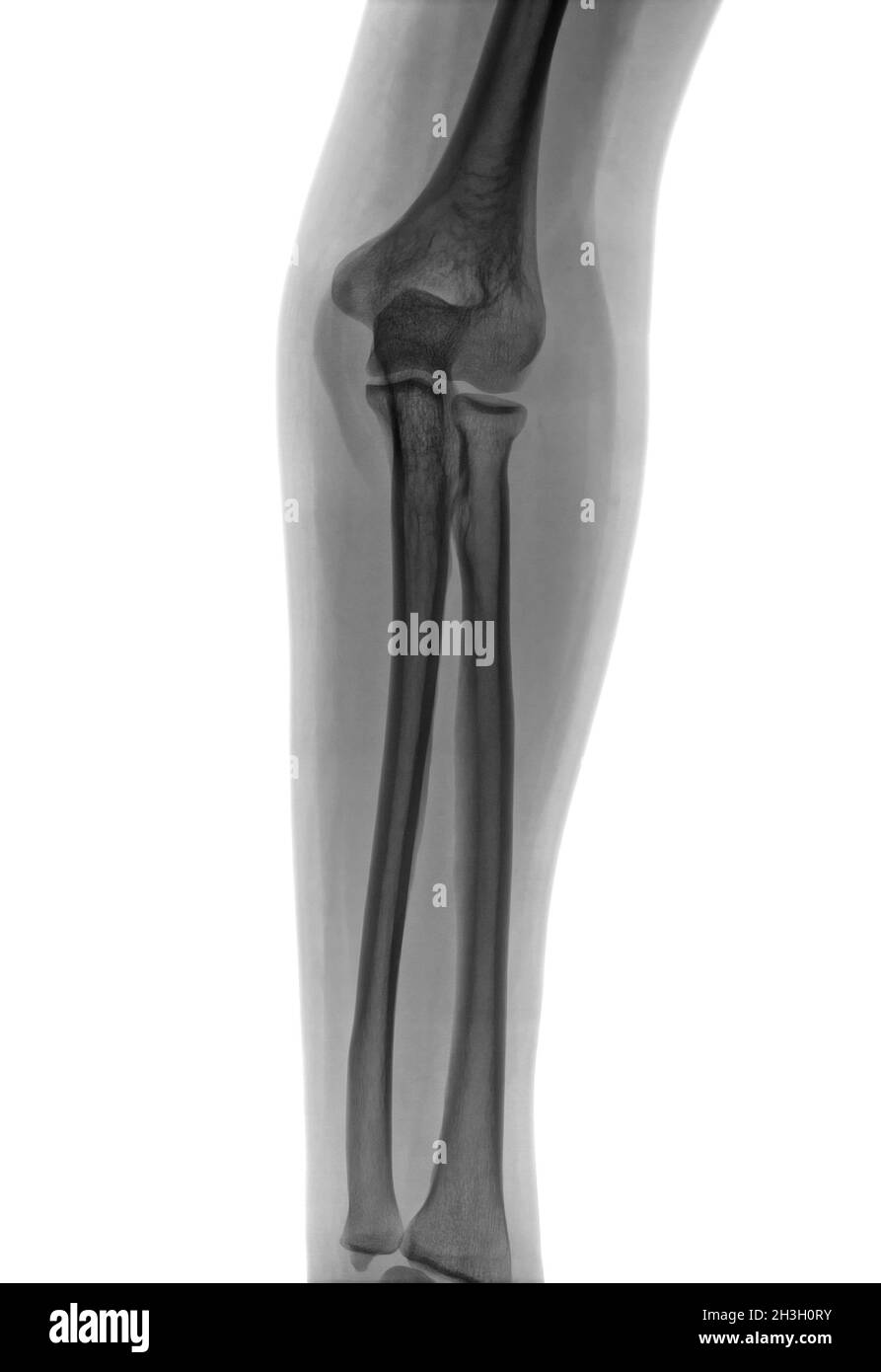 Elbow X-ray negative Stock Photo - Alamy