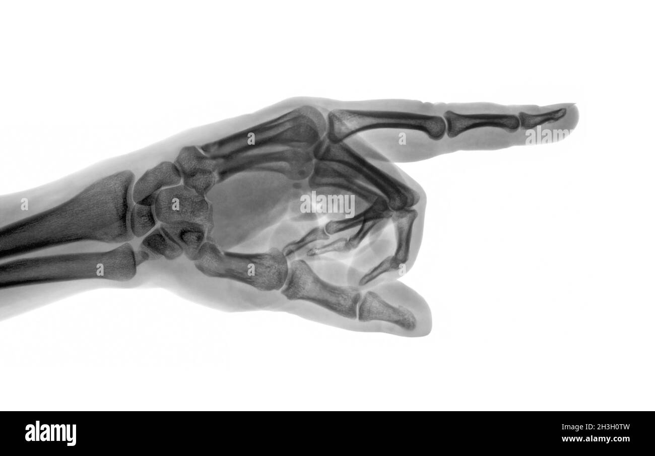 Broken thumb x ray hi-res stock photography and images - Alamy
