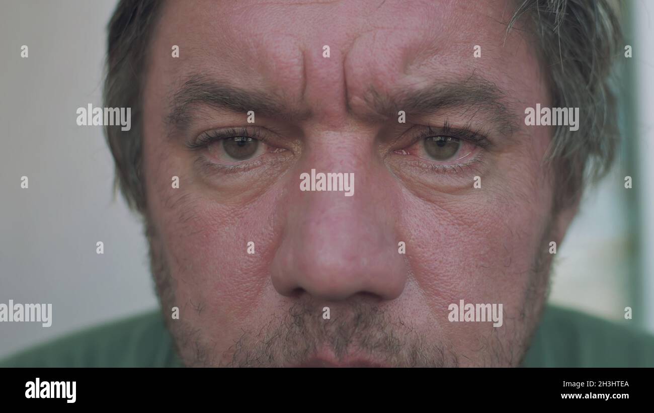 portrait of a homeless alcoholic man with red eyes and a swollen ...