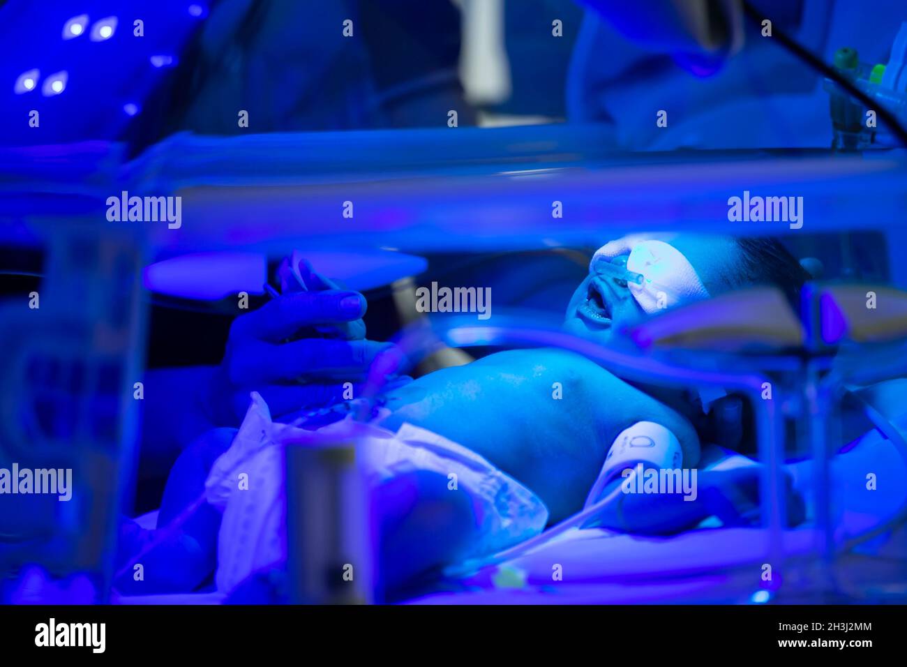 Newborn child baby having a treatment for jaundice under ultraviolet ...