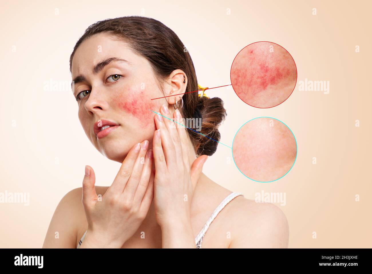 Portrait of a young Caucasian woman showing redness and inflamed blood ...