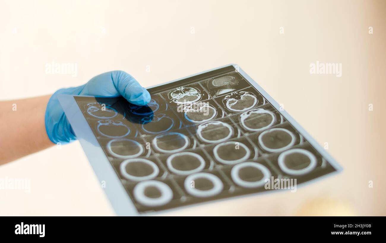 A doctor holds out a tomographic scan to the camera. A series of ...