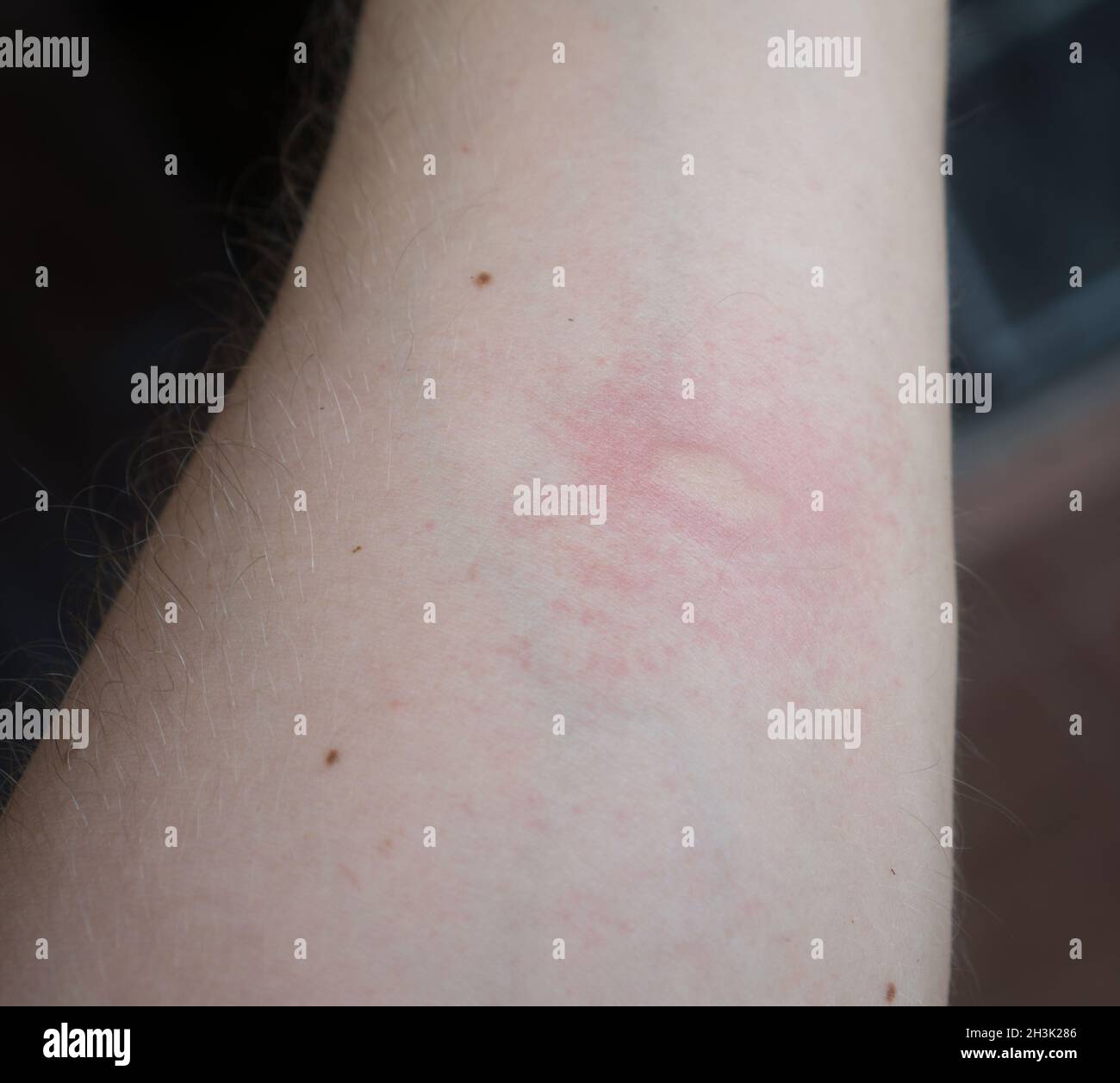 Hand with insect bite Stock Photo - Alamy