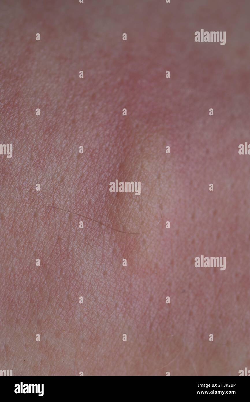 Hand with insect bite Stock Photo - Alamy