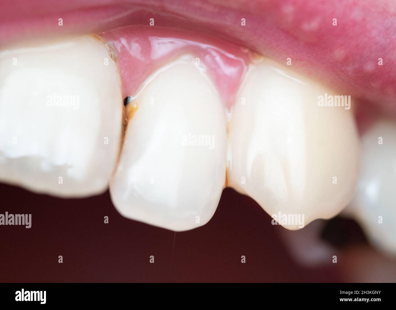 Male teeth hi-res stock photography and images - Alamy