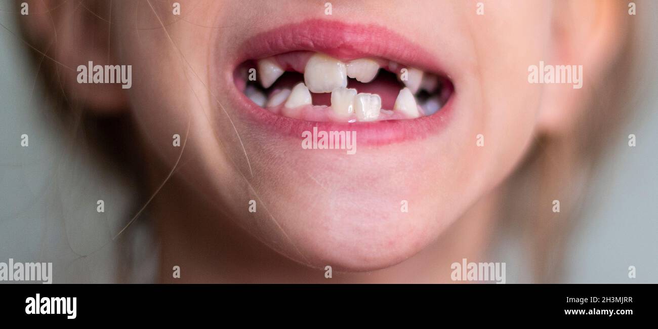 Teeth for children hi-res stock photography and images - Alamy